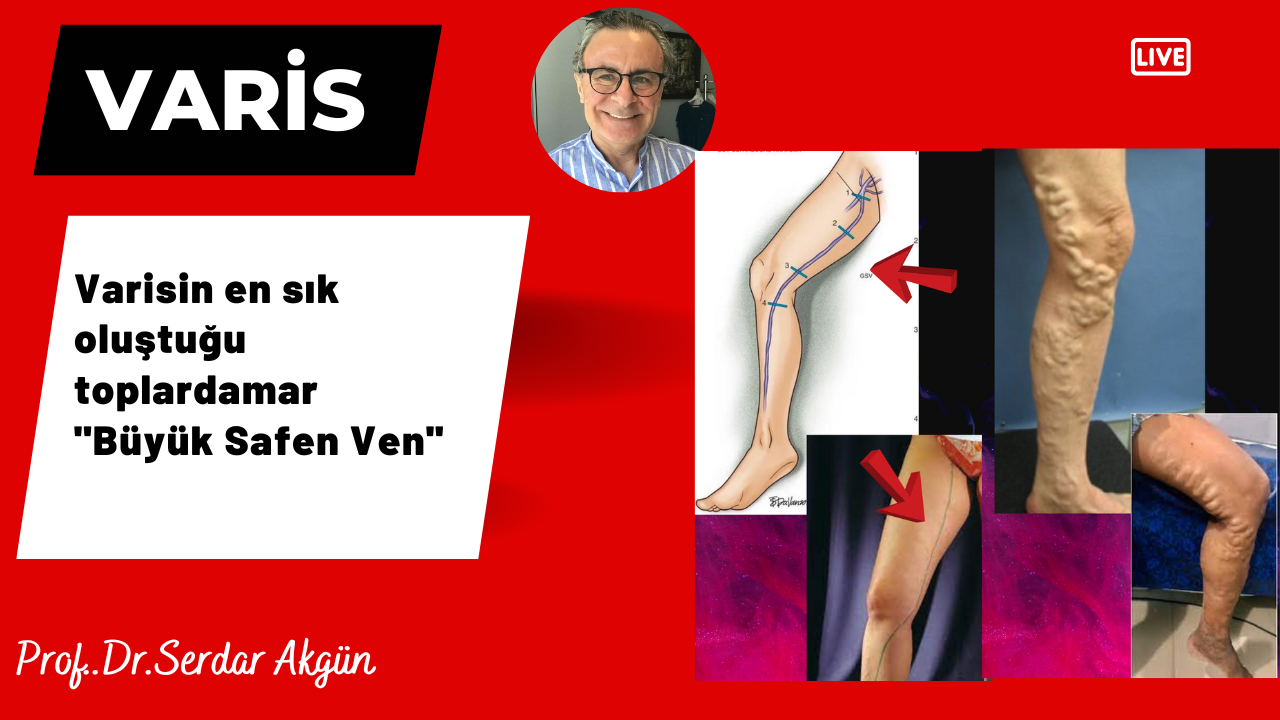 Varis ve İç varis nasıl olur? | Prof.Dr. Serdar Akgün