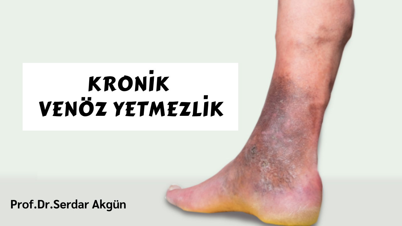 Kronik Venöz Yetmezlik | Prof.Dr. Serdar Akgün